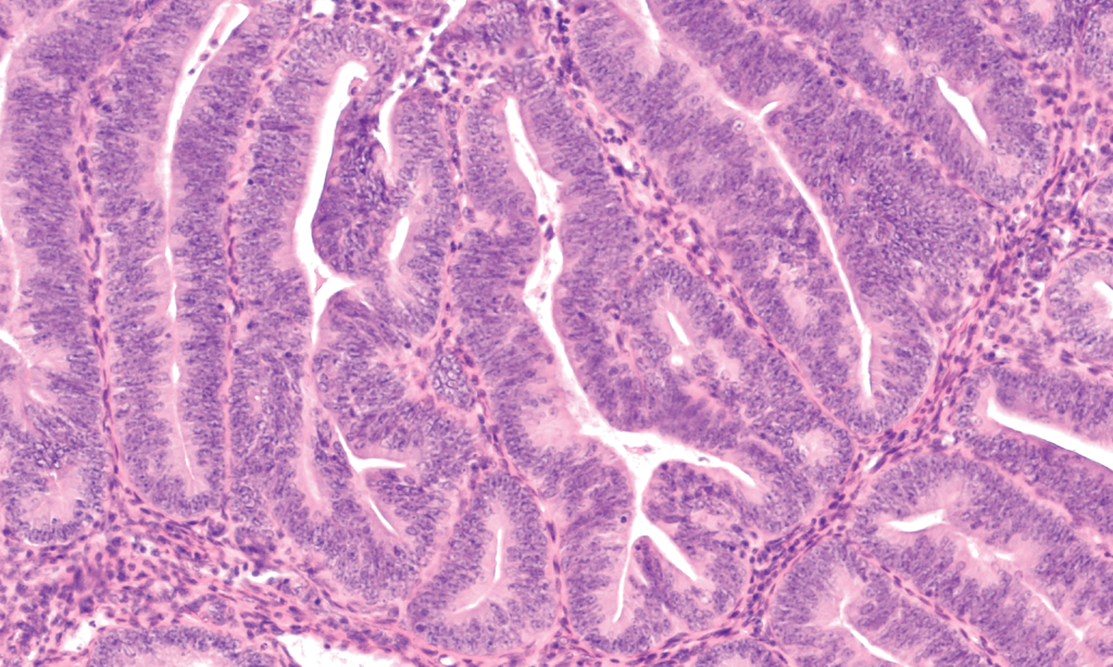 New model offers powerful tool for studying endometrial cancer – Van ...