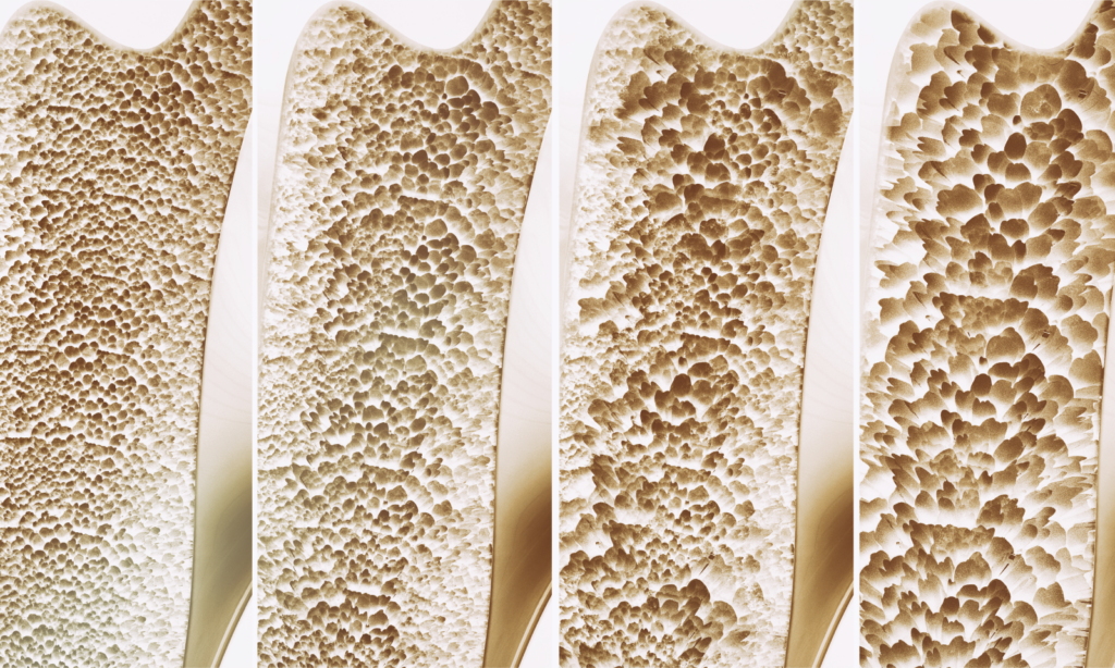 Osteoporosis treatments may benefit from discovery of key driver of low ...