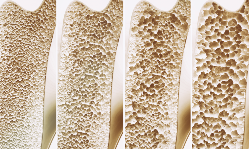 Osteoporosis treatments may benefit from discovery of key driver of low ...